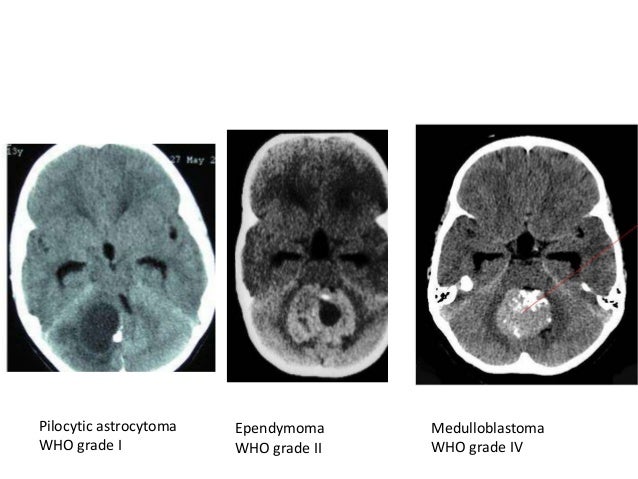 Ependymoma Brain Tumor