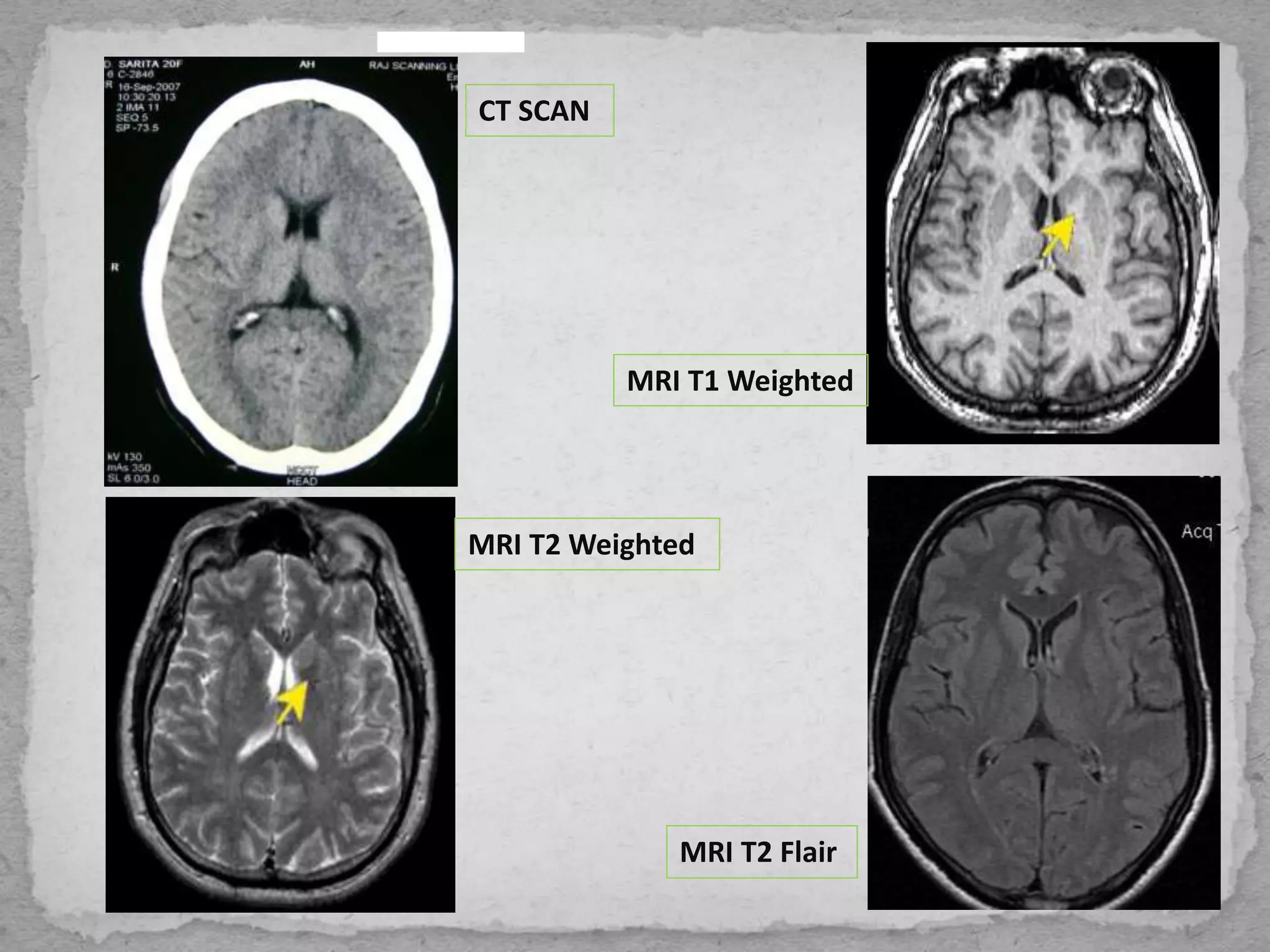 Mri in ent | PPTX