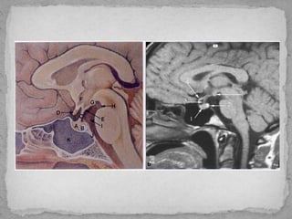 Mri in ent | PPTX