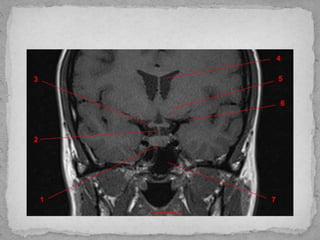 Mri in ent | PPTX