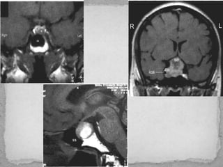 Mri in ent | PPTX