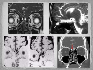 Mri in ent | PPTX