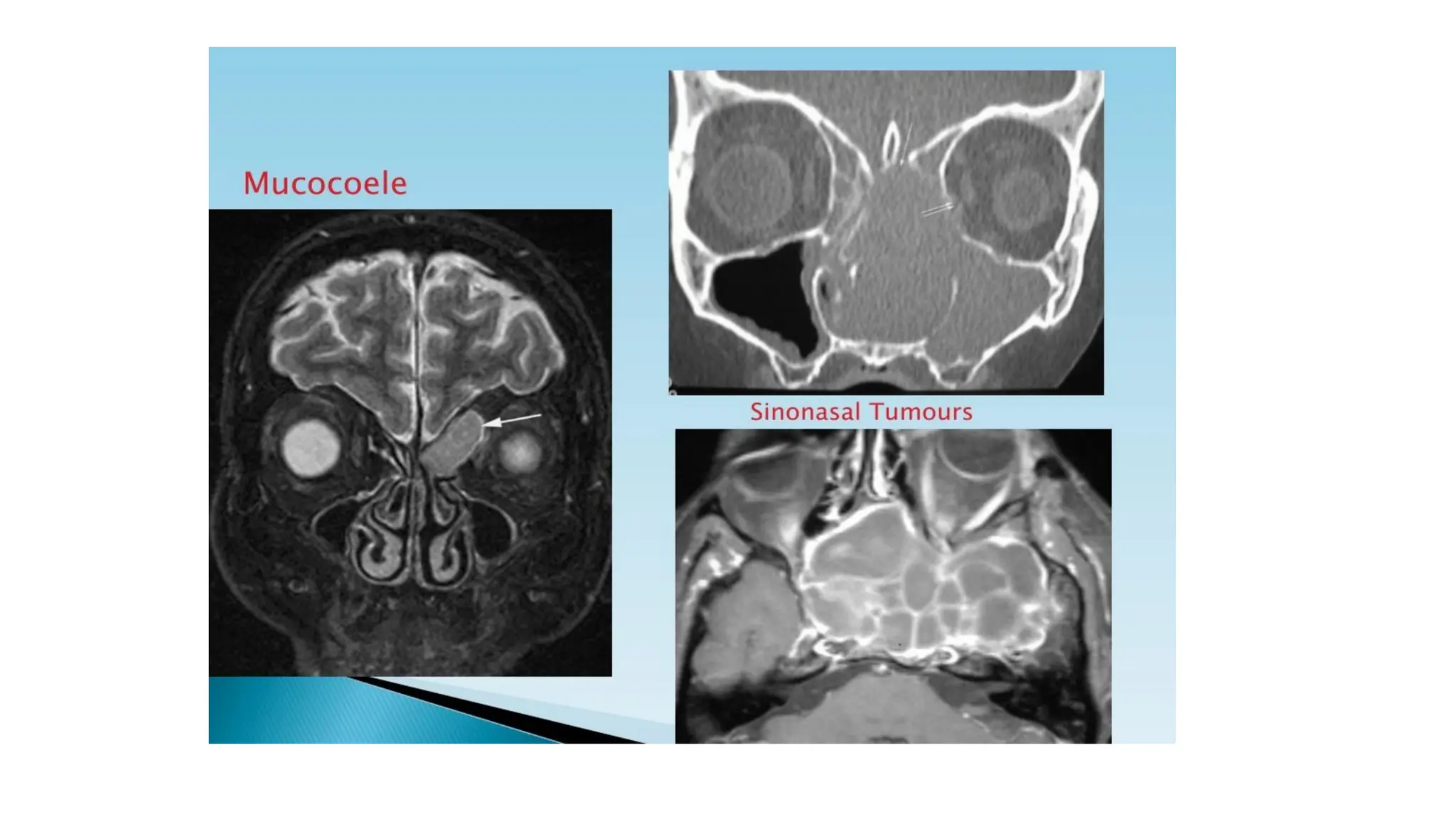 mri in ent final for learning purpose.pptx