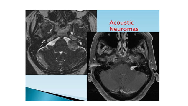 mri in ent final for learning purpose.pptx | Medical Tests | Medical Health