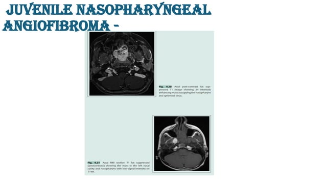 mri in ent final for learning purpose.pptx | Medical Tests | Medical Health