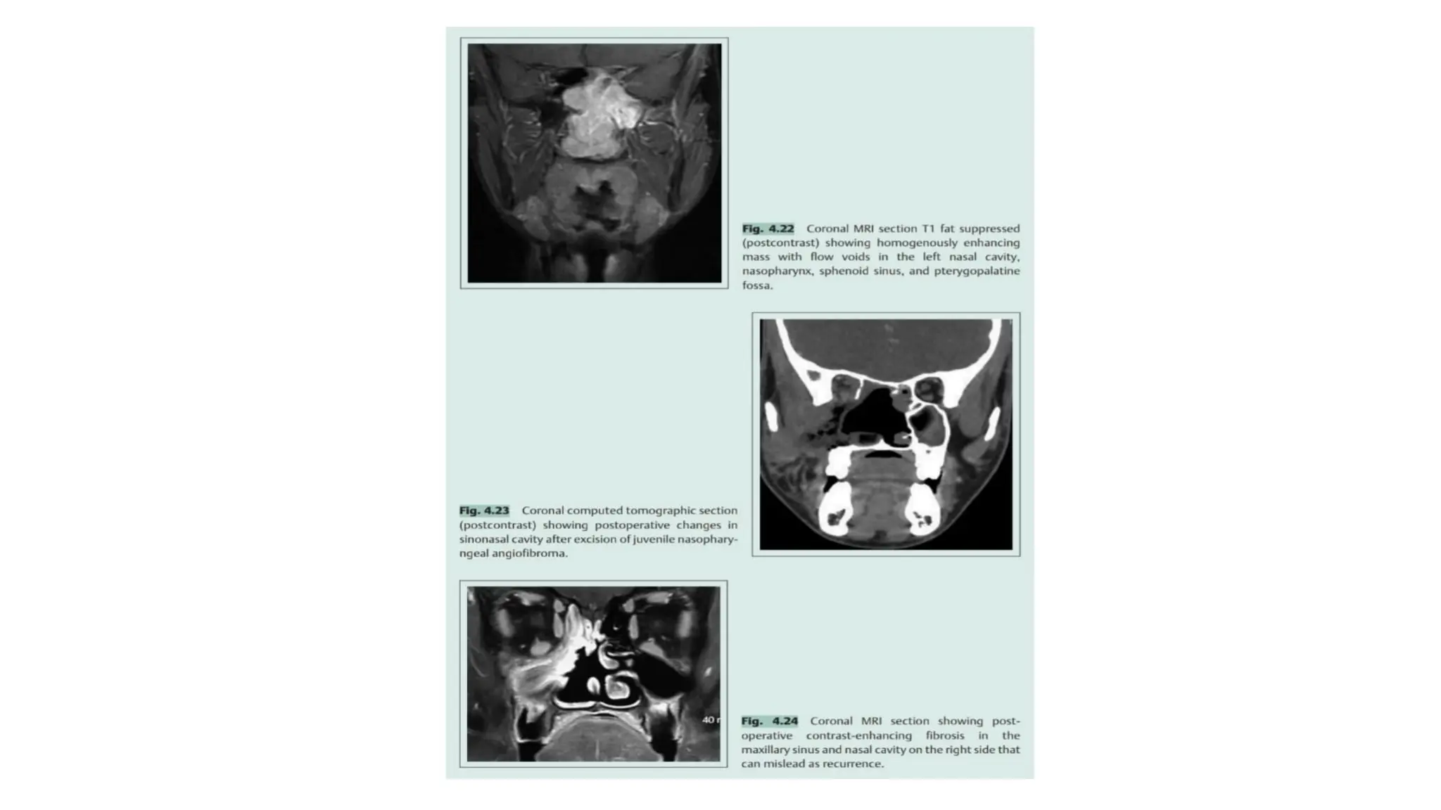 mri in ent final nejshdifndhsjjsbdhxhcopy.pptx