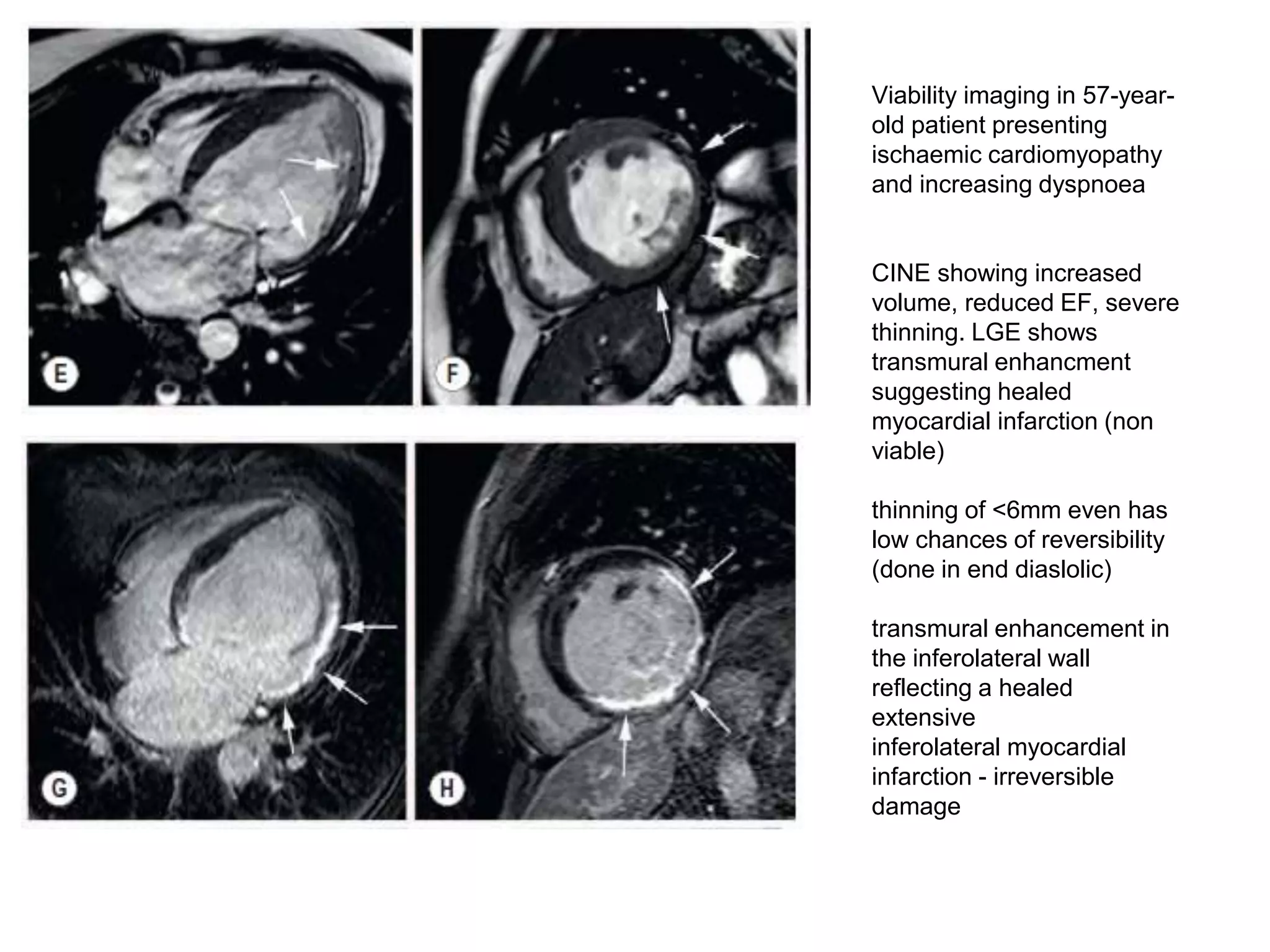 CARDIAC MRI IN ISCHEMIC HEART DISEASES | PPTX