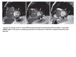 CARDIAC MRI IN ISCHEMIC HEART DISEASES | PPTX