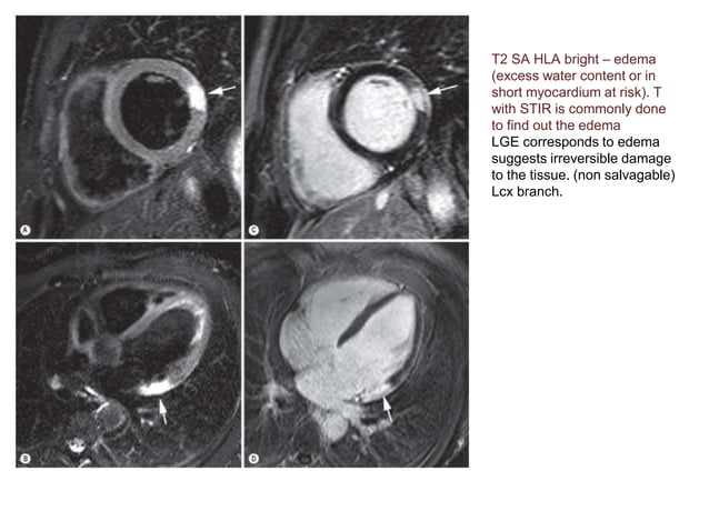 CARDIAC MRI IN ISCHEMIC HEART DISEASES | PPTX | Heart and ...