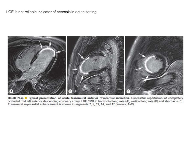 CARDIAC MRI IN ISCHEMIC HEART DISEASES | PPTX | Heart and ...