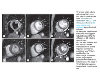 CARDIAC MRI IN ISCHEMIC HEART DISEASES | PPTX