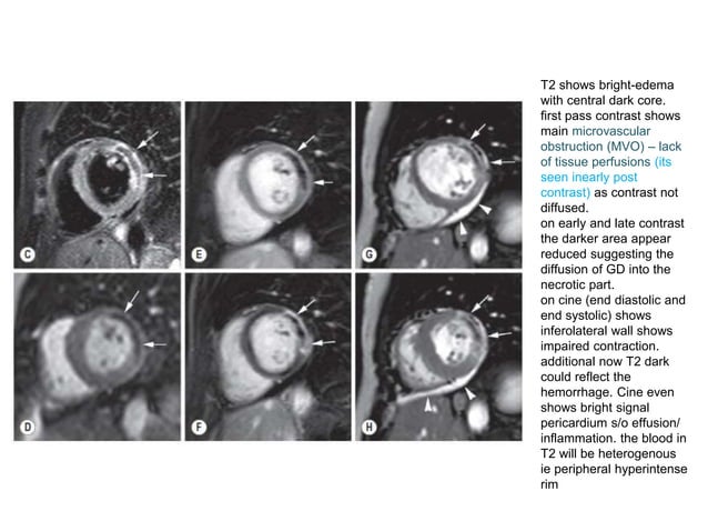 CARDIAC MRI IN ISCHEMIC HEART DISEASES | PPTX | Heart and ...