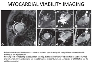 CARDIAC MRI IN ISCHEMIC HEART DISEASES | PPTX