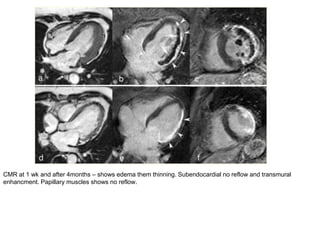 CARDIAC MRI IN ISCHEMIC HEART DISEASES | PPTX