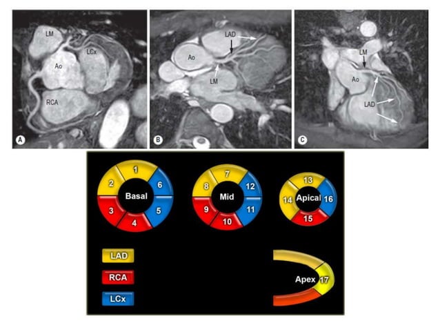 CARDIAC MRI IN ISCHEMIC HEART DISEASES | PPTX | Heart and ...
