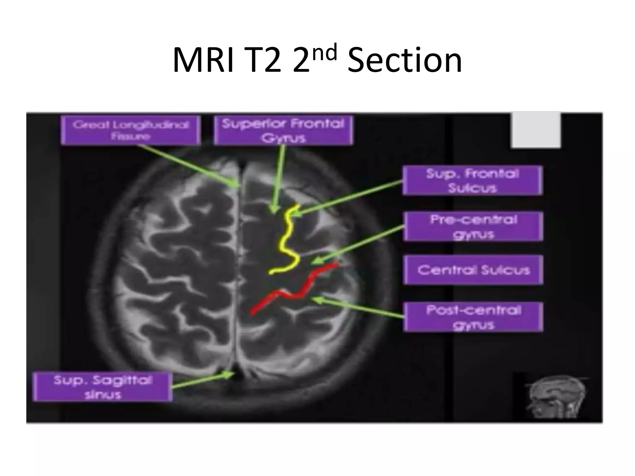 Neonatal MRI Brain | PPTX