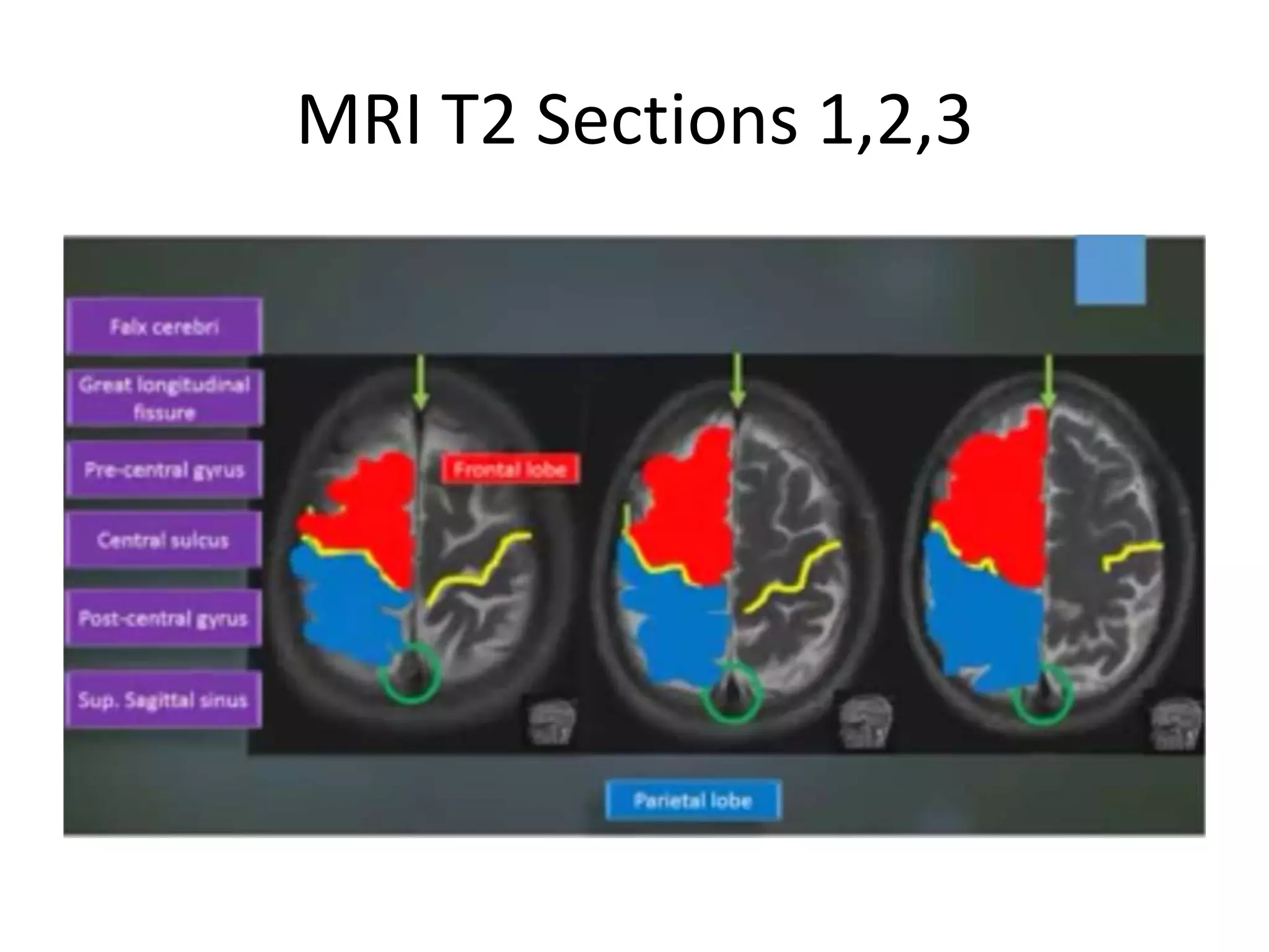 Neonatal MRI Brain | PPTX