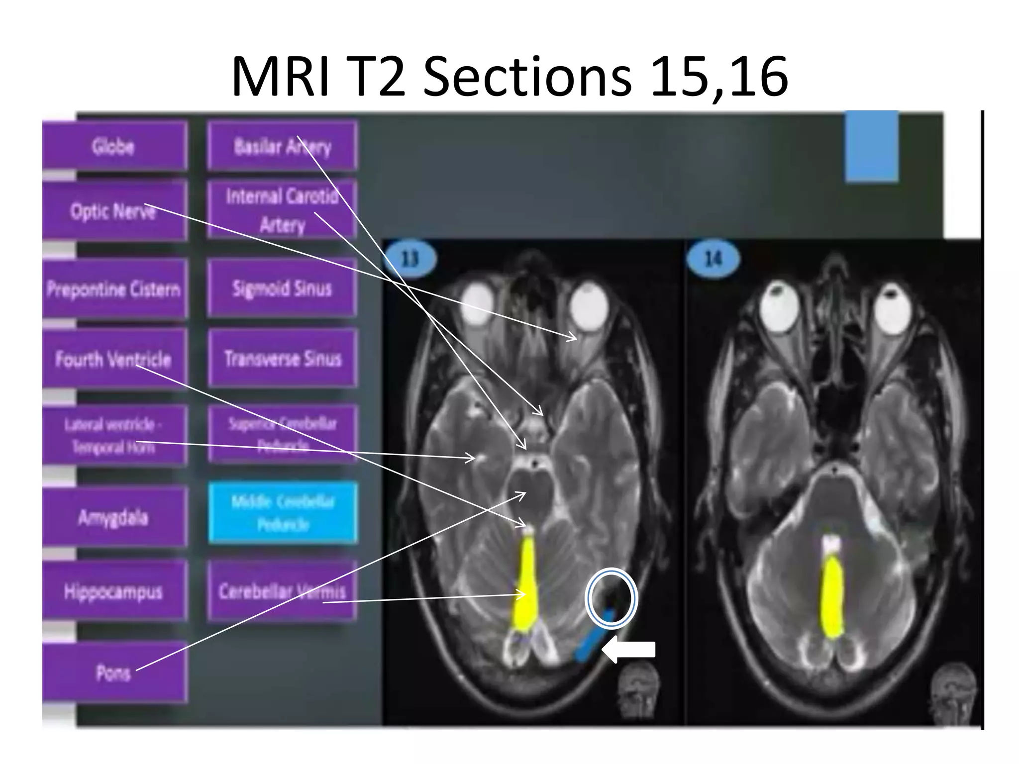 Neonatal MRI Brain | PPTX