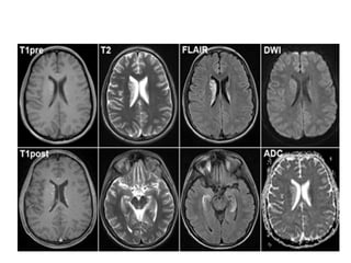 Neonatal MRI Brain | PPTX