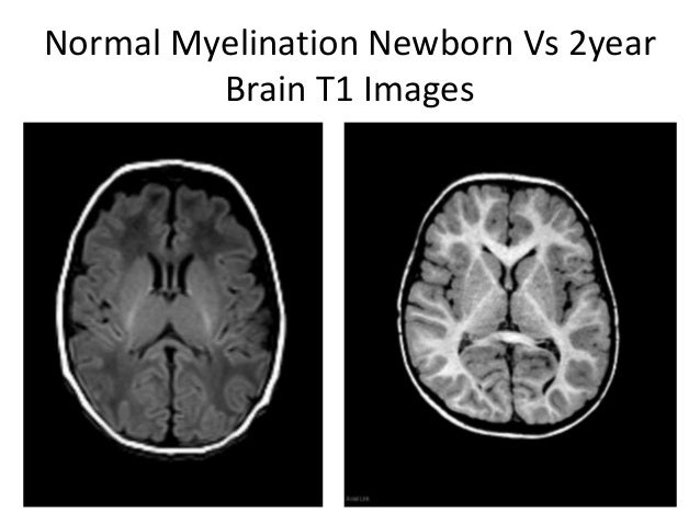Neonatal MRI Brain