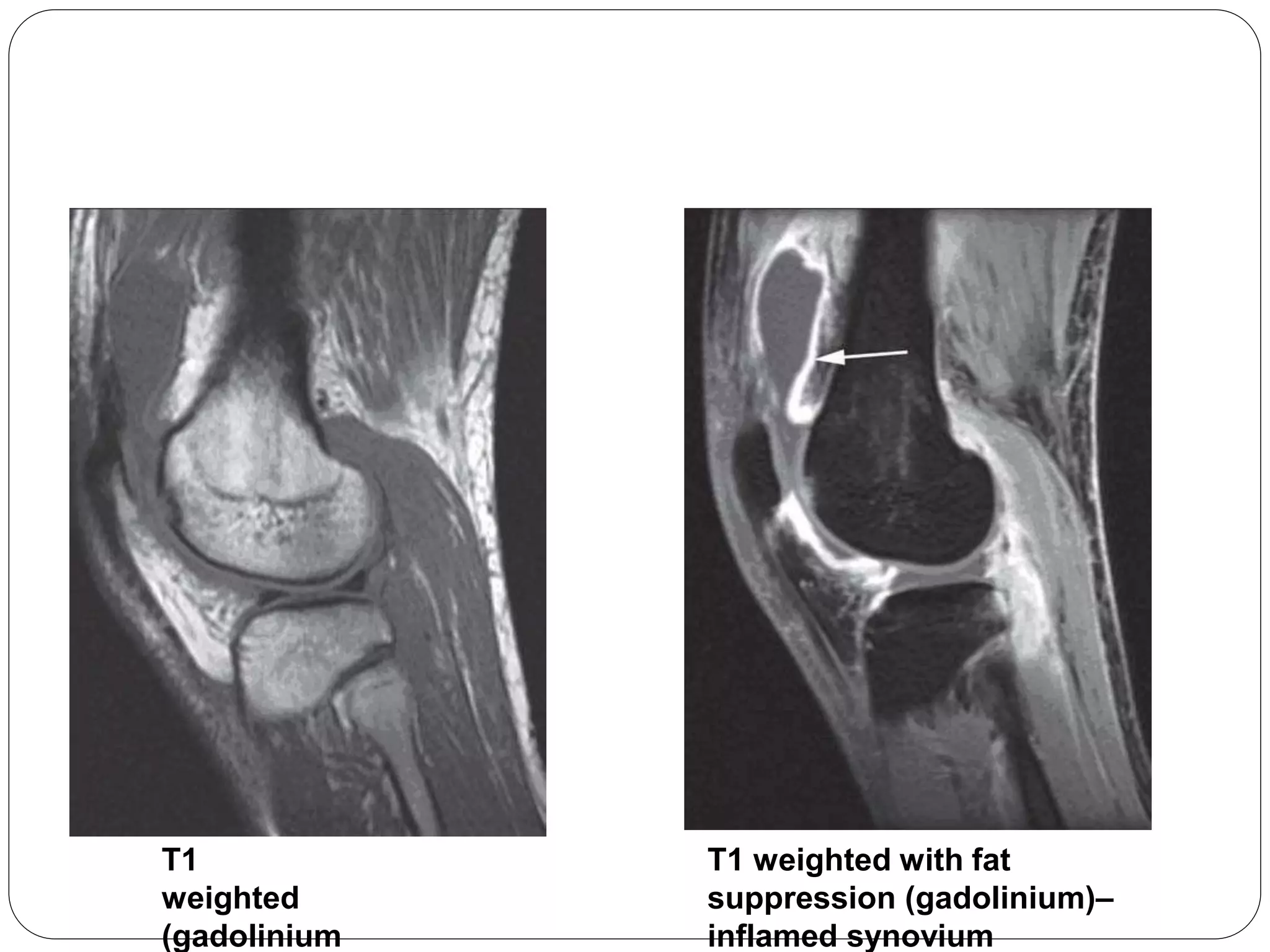 MRI in orthopaedics | PPTX