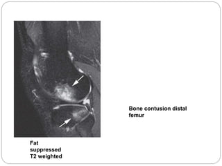 MRI in orthopaedics | PPTX
