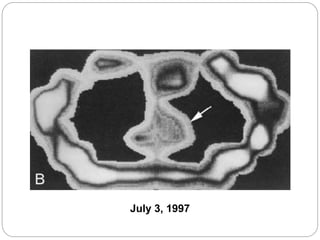 MRI in orthopaedics | PPTX