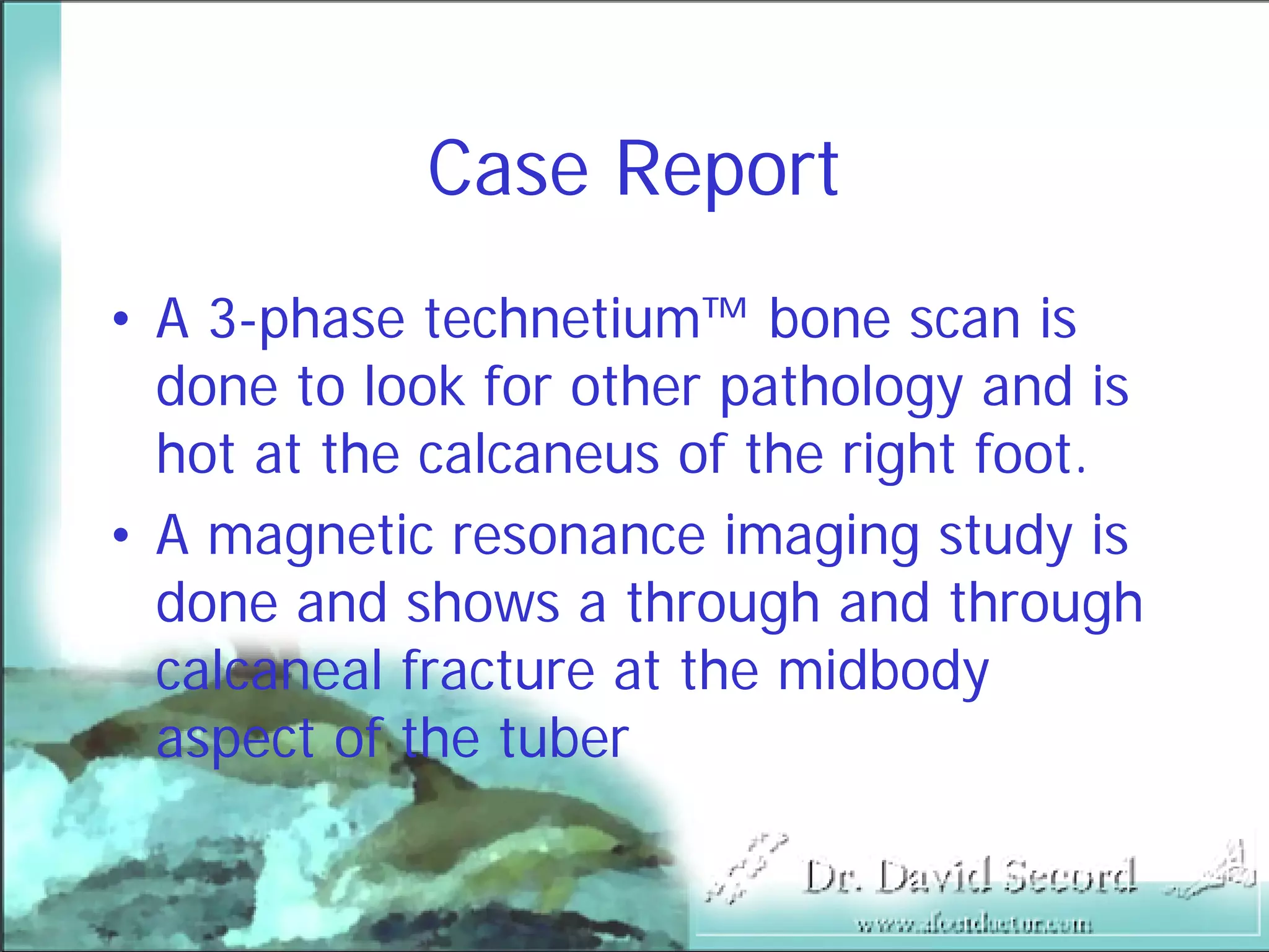 Mri In Stress Fractures | PDF