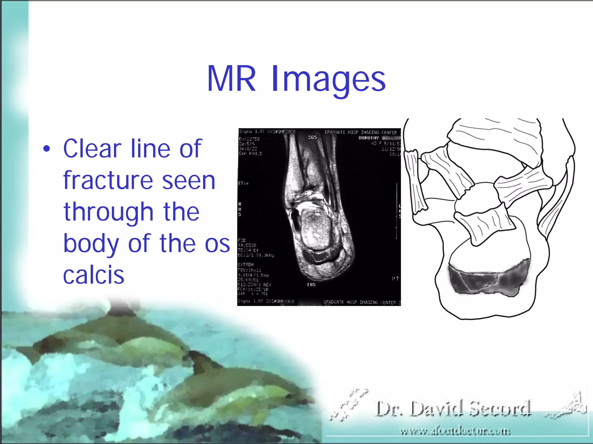 Mri In Stress Fractures | PDF