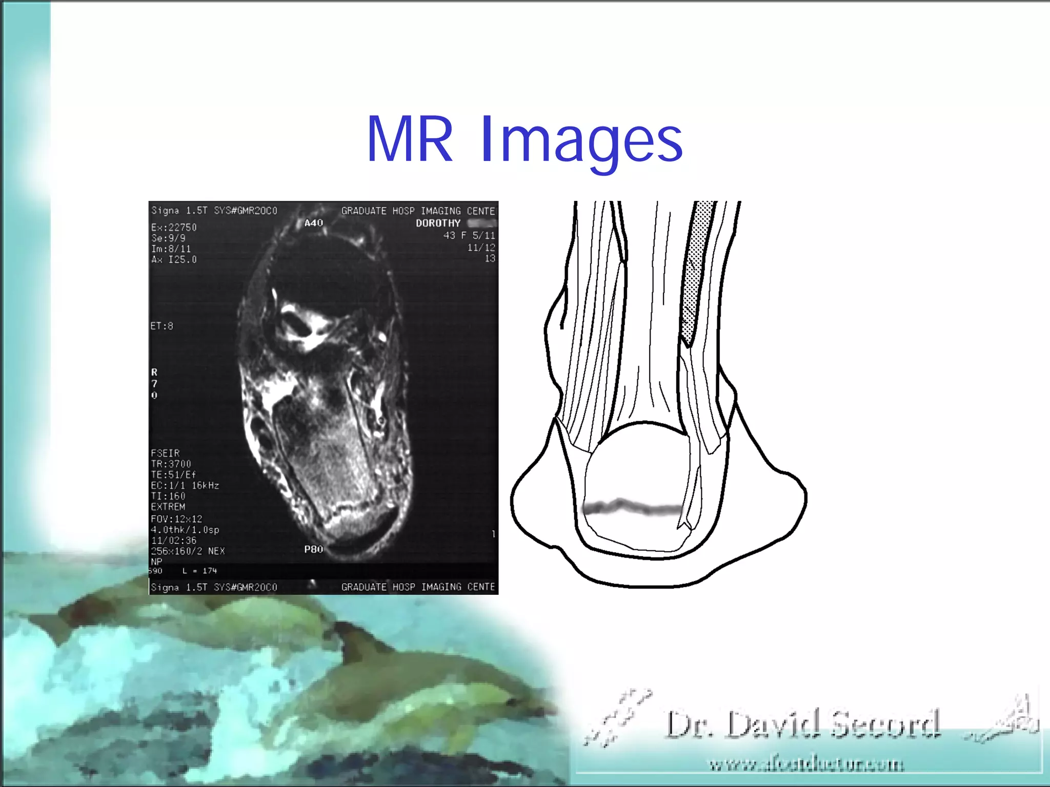 Mri In Stress Fractures | PDF