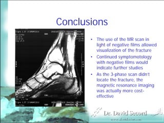 Mri In Stress Fractures | PDF