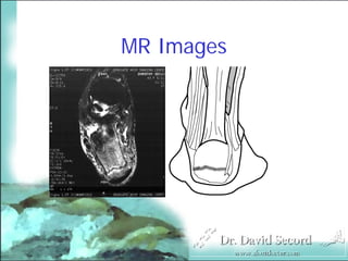 Mri In Stress Fractures | PDF