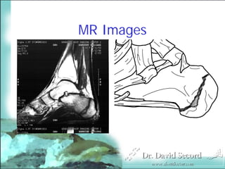 Mri In Stress Fractures | PDF