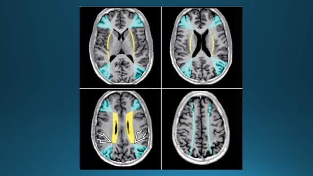 MRI IN STROKE RADIOLOGY PRESENTATION... | PPTX