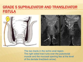 Mri in surgery | PPT