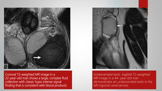 Mri in urology | PPTX