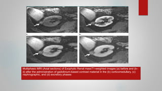 Mri in urology | PPTX