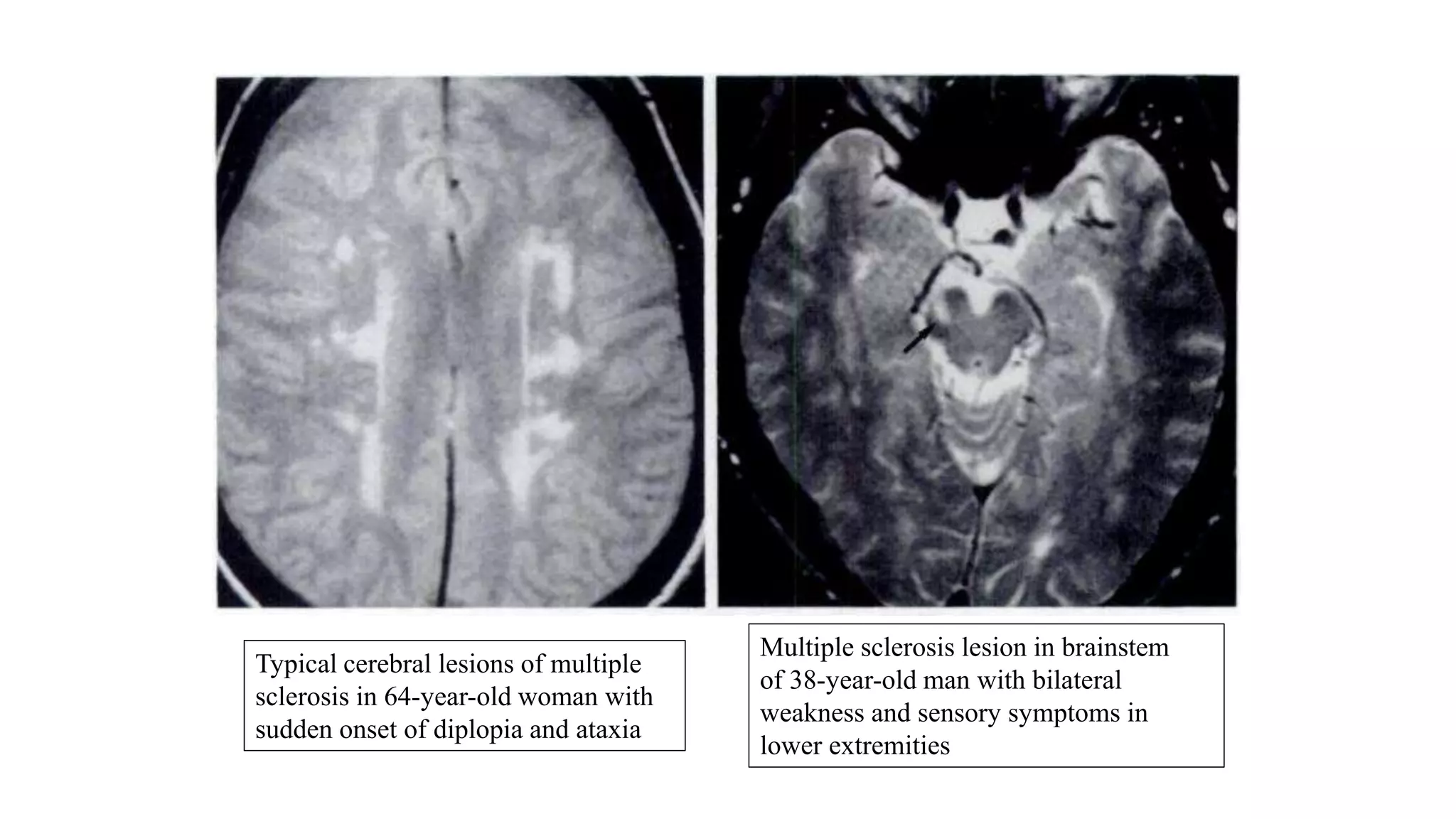 Mri in white matter diseases | PPTX