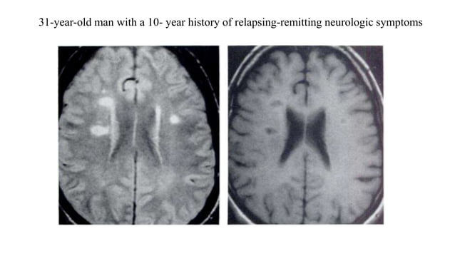 Mri in white matter diseases | PPTX | Brain and Nervous System ...
