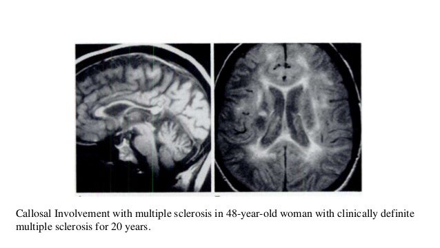 mild nonspecific bilateral supratentorial white matter disease ...