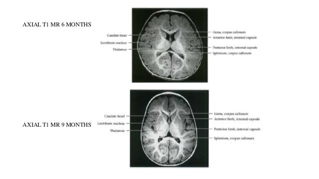 Mri in white matter diseases