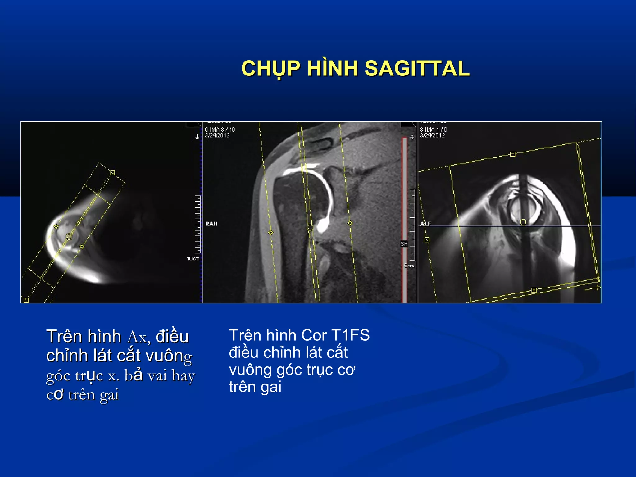 Mri khớp vai | PPT