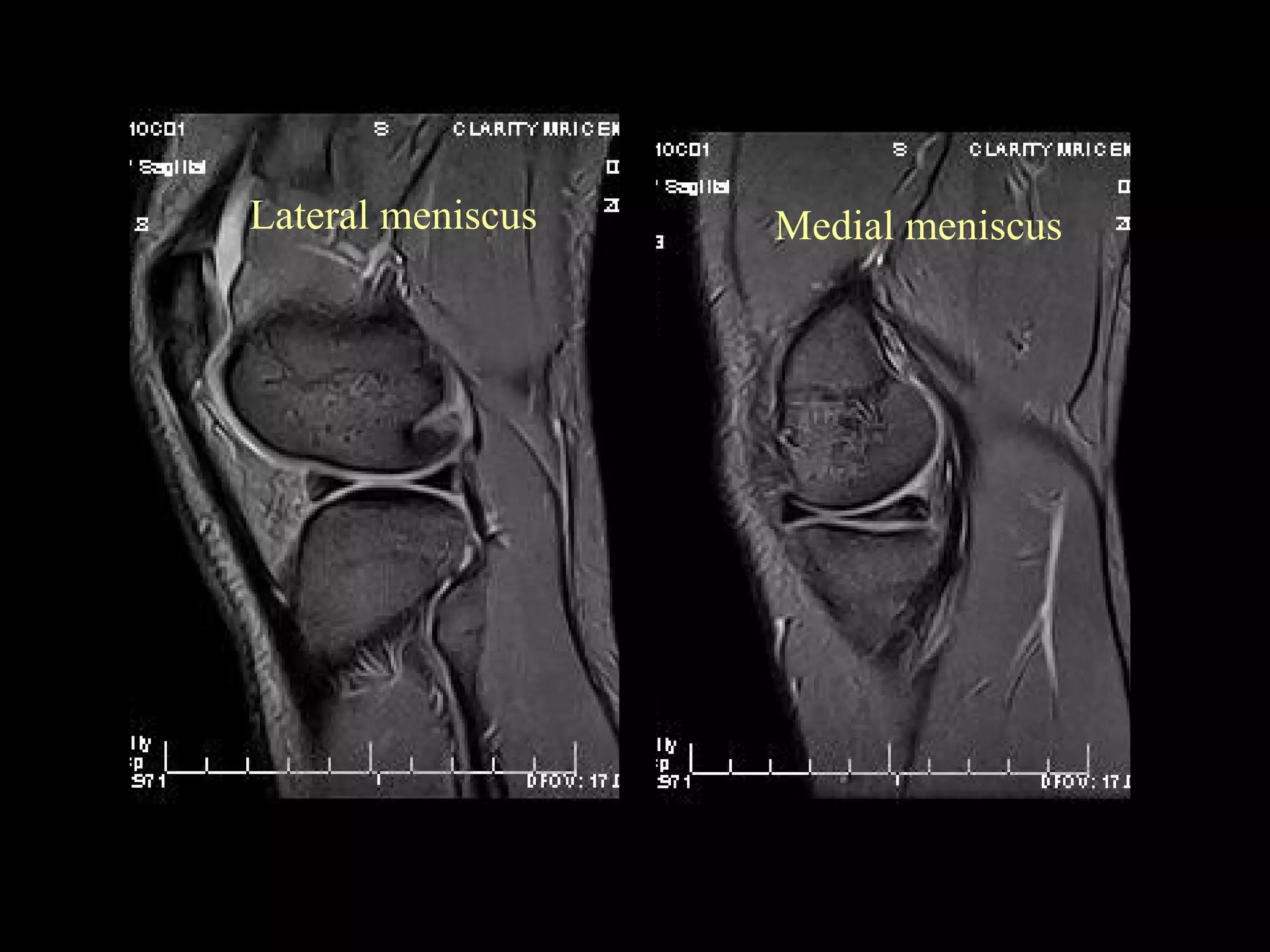 MRI Knee - Basics | PPT
