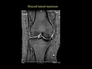 MRI Knee - Basics | PPT