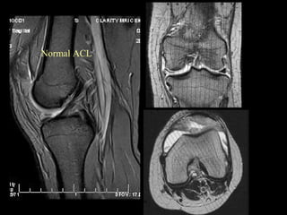 MRI Knee - Basics | PPT