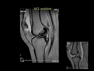 MRI Knee - Basics | PPT
