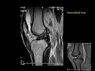 MRI Knee - Basics | PPT
