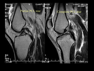 MRI Knee - Basics | PPT