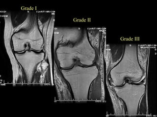 MRI Knee - Basics | PPT