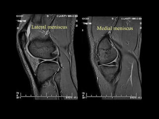 MRI Knee - Basics | PPT
